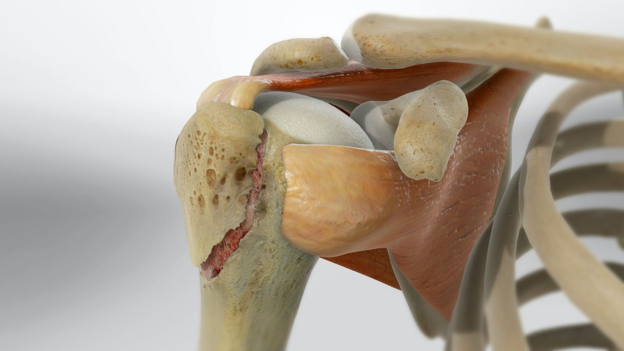 Fractura proximal del húmero: tratamiento fisioterapéutico ...